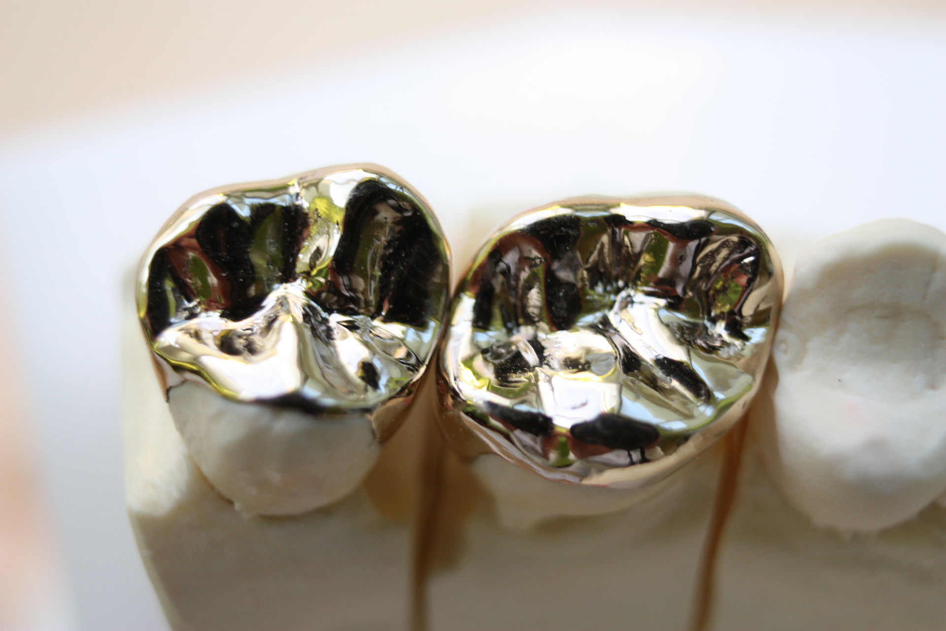 Zahngold: Soviel ist ihr Goldzahn wirklich wert